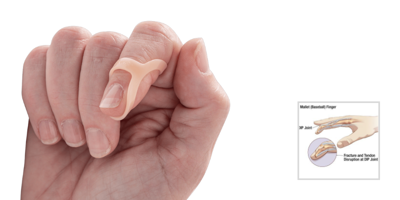 Splinting Options For Treating A Mallet Finger